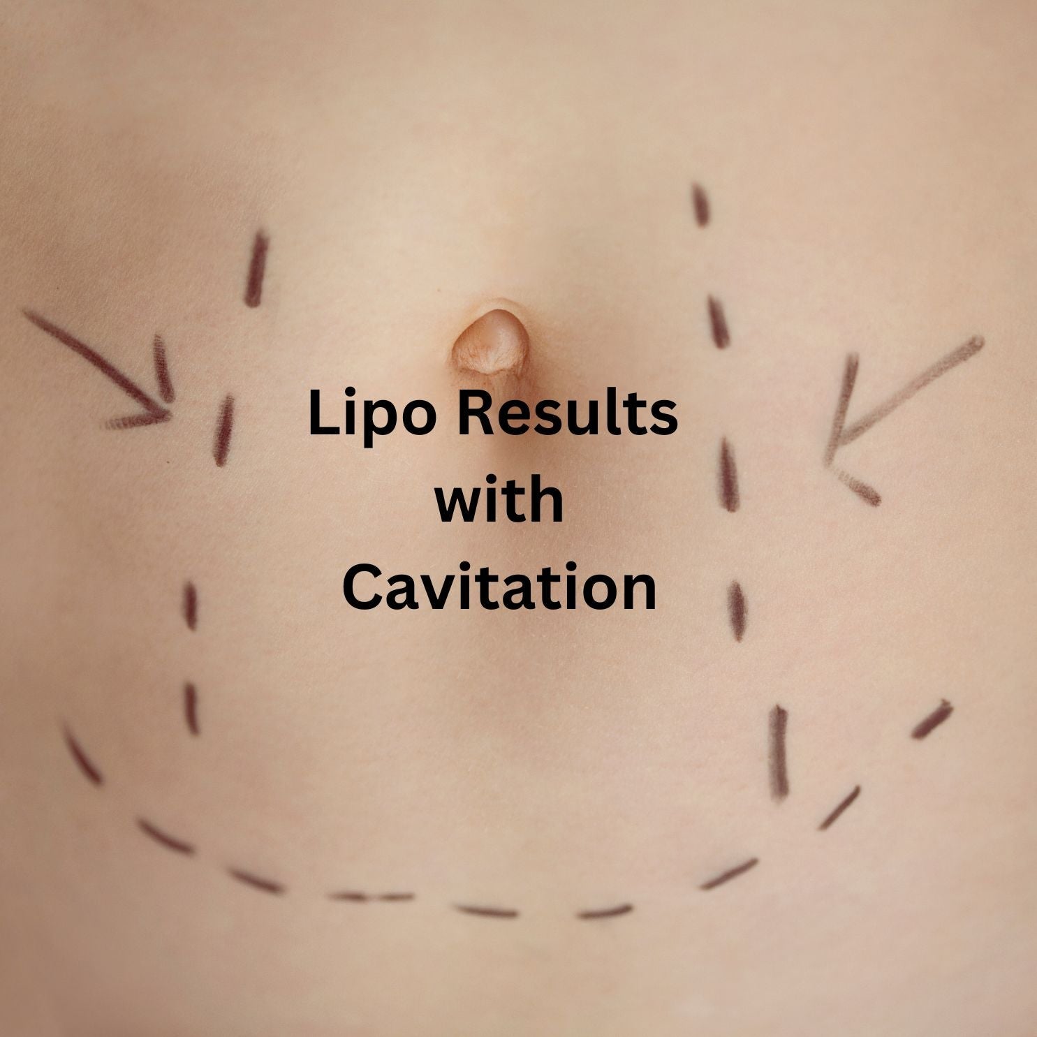 Achieving Stomach Liposuction Results with Ultrasonic Cavitation ...